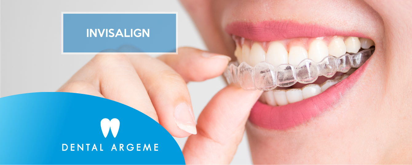 ¿ESTÁS PENSANDO EN COLOCARTE LOS DIENTES? - Clinica Dental Argeme